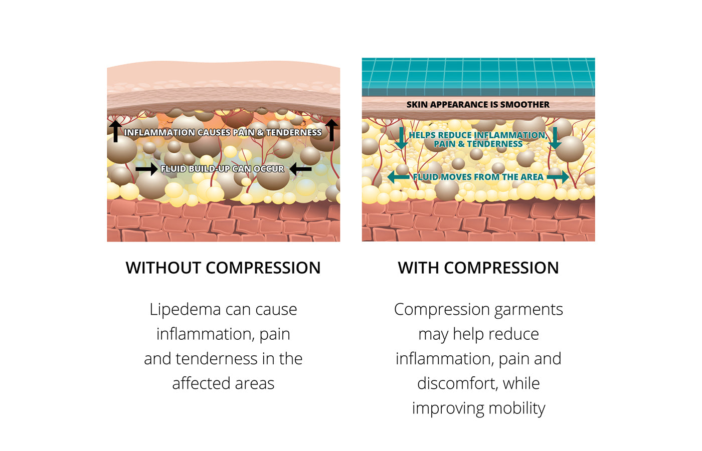 Lipedema Compression Guide: Post-Surgical Benefits & Solutions – The ...