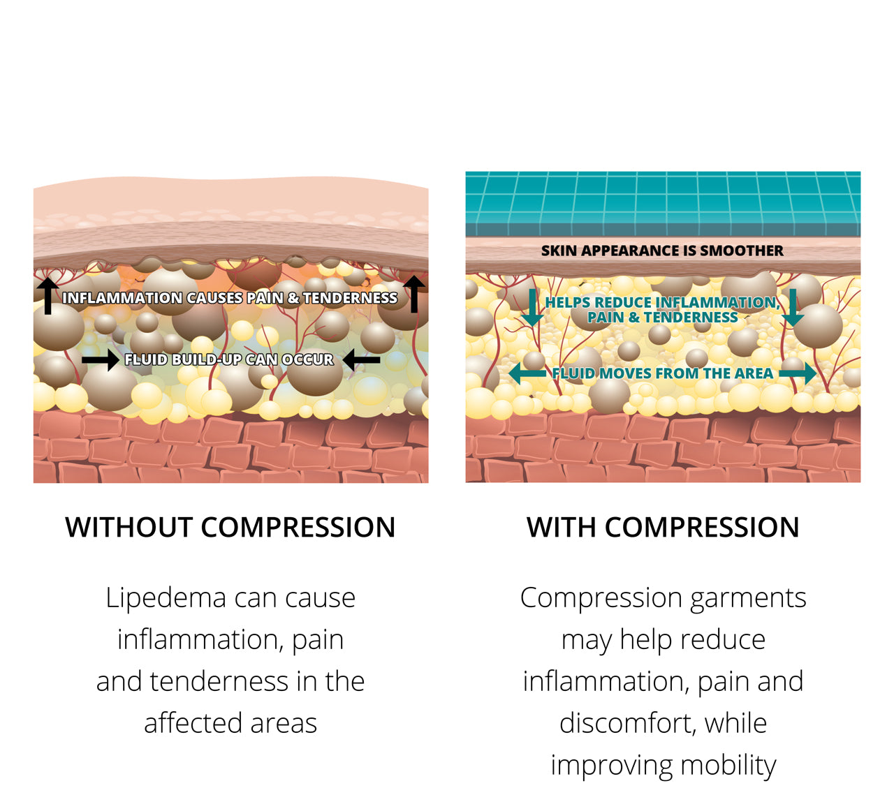 Lipedema Compression Guide: Post-Surgical Benefits & Solutions - The ...